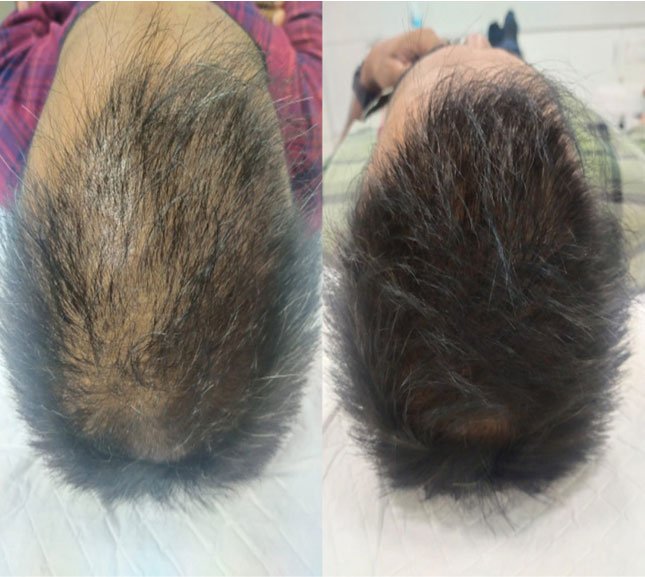 Hair Restoration